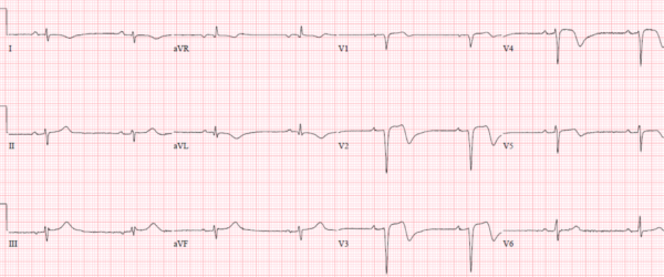 ECG Cases 16: poor R-wave progression - LATE mnemonic | ECG Cases