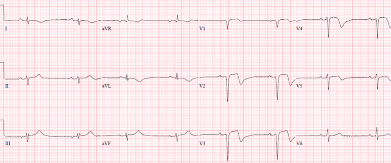 ECG Cases 16: poor R-wave progression - LATE mnemonic | ECG Cases
