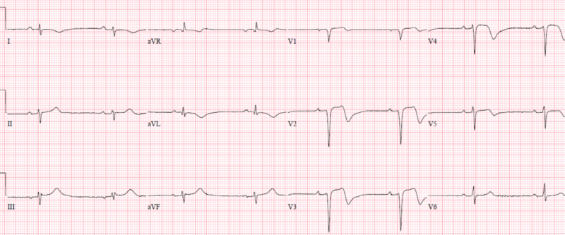 ECG Cases 16: poor R-wave progression - LATE mnemonic | ECG Cases