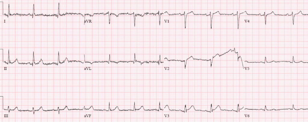 ECG Cases 16: poor R-wave progression - LATE mnemonic | ECG Cases