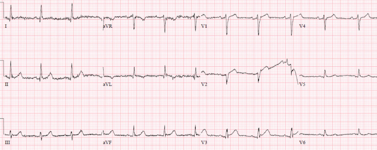 ECG Cases 16: poor R-wave progression - LATE mnemonic | ECG Cases