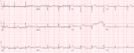 ECG Cases 16: poor R-wave progression - LATE mnemonic | ECG Cases