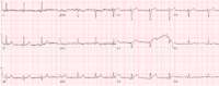ECG Cases 16: poor R-wave progression - LATE mnemonic | ECG Cases
