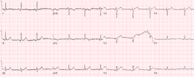 ECG Cases 16: poor R-wave progression - LATE mnemonic | ECG Cases