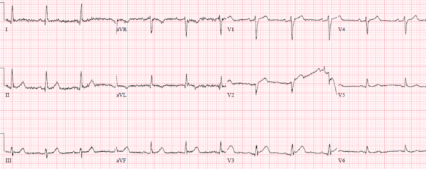 ECG Cases 16: poor R-wave progression - LATE mnemonic | ECG Cases