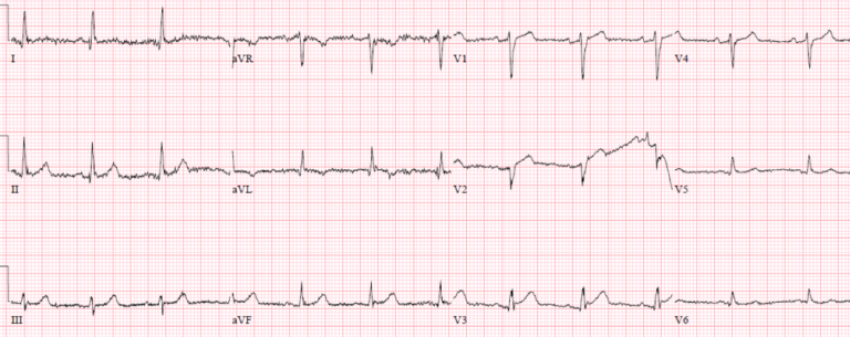 ECG Cases 16: poor R-wave progression - LATE mnemonic | ECG Cases
