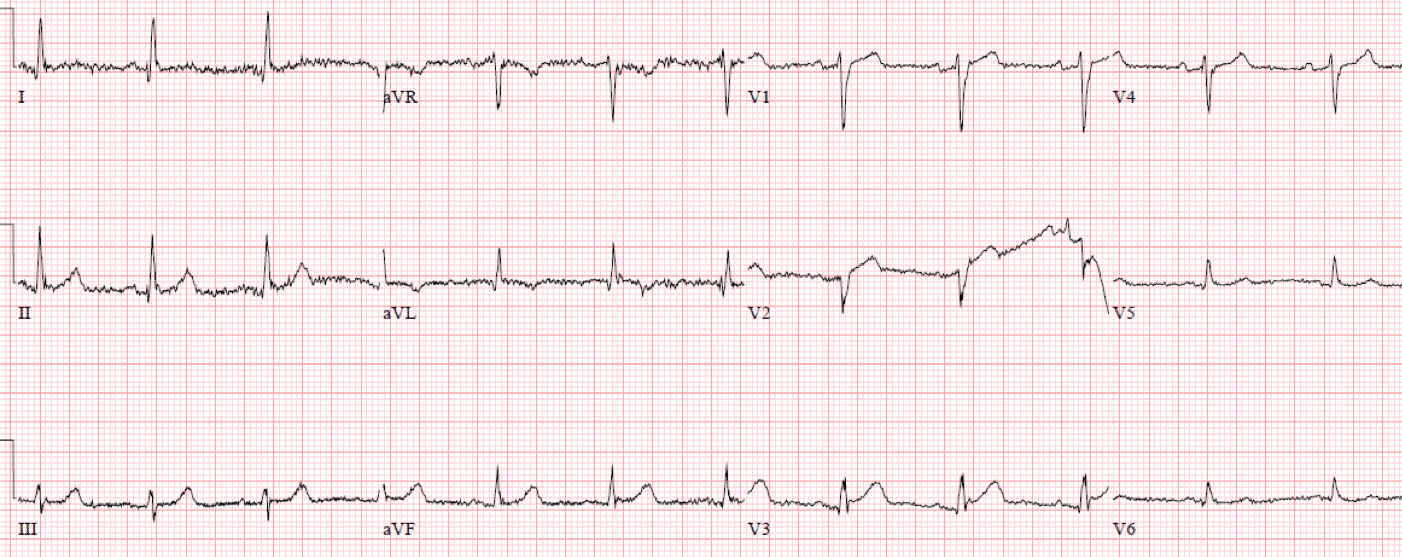 ECG Cases 16: poor R-wave progression - LATE mnemonic | ECG Cases
