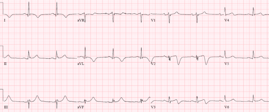 ECG Cases 16: poor R-wave progression - LATE mnemonic | ECG Cases