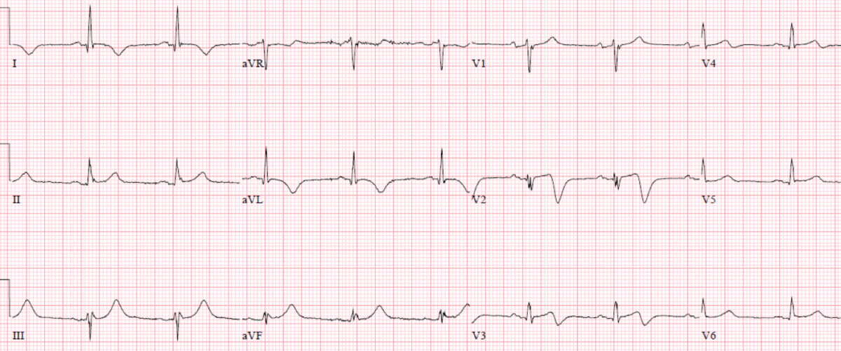 ECG Cases 16: poor R-wave progression - LATE mnemonic | ECG Cases