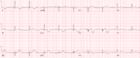 ECG Cases 16: poor R-wave progression - LATE mnemonic | ECG Cases