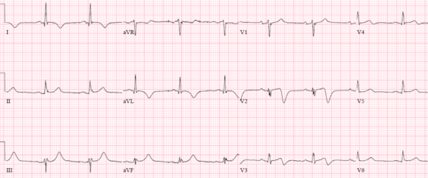 ECG Cases 16: poor R-wave progression - LATE mnemonic | ECG Cases