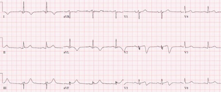 ECG Cases 16: poor R-wave progression - LATE mnemonic | ECG Cases