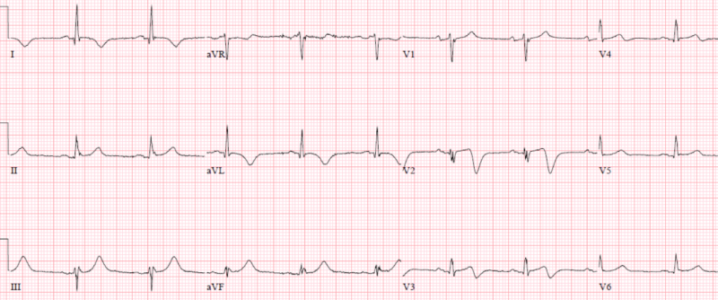 ECG Cases 16: poor R-wave progression - LATE mnemonic | ECG Cases