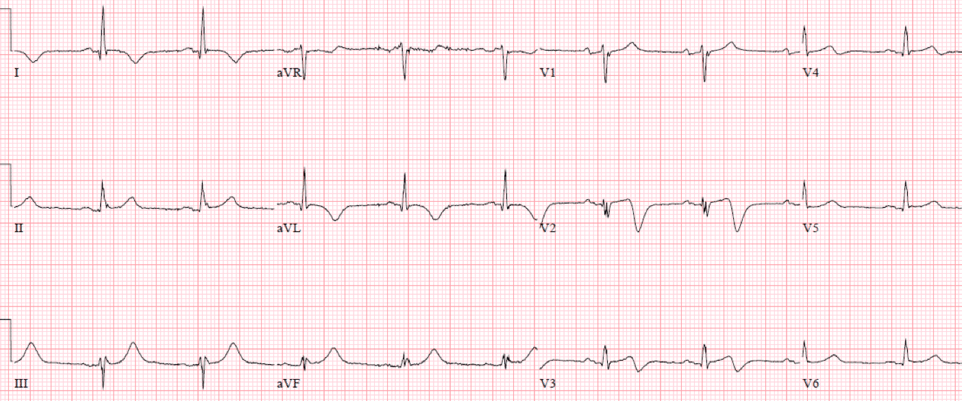 ECG Cases 16: poor R-wave progression - LATE mnemonic | ECG Cases
