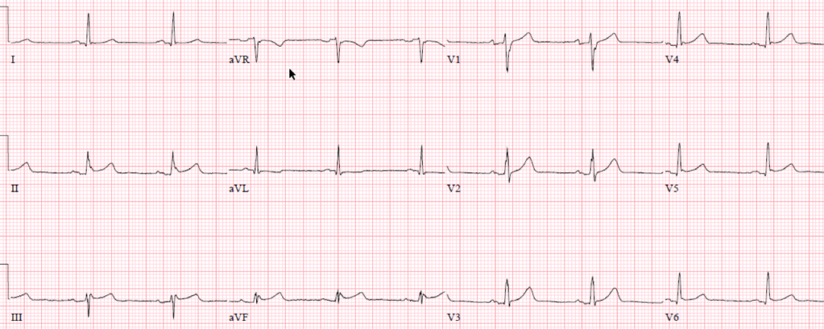 ECG Cases 16: poor R-wave progression - LATE mnemonic | ECG Cases