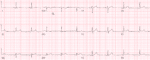 ECG Cases 16: poor R-wave progression - LATE mnemonic | ECG Cases