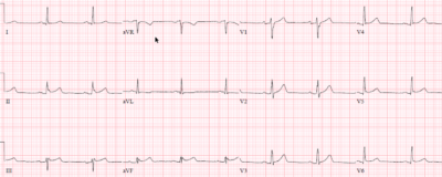 ECG Cases 16: poor R-wave progression - LATE mnemonic | ECG Cases