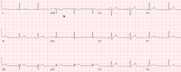 ECG Cases 16: poor R-wave progression - LATE mnemonic | ECG Cases