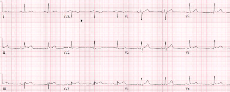 ECG Cases 16: poor R-wave progression - LATE mnemonic | ECG Cases