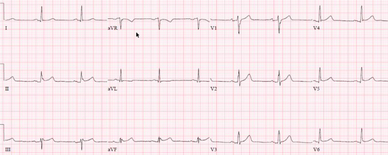 ECG Cases 16: poor R-wave progression - LATE mnemonic | ECG Cases