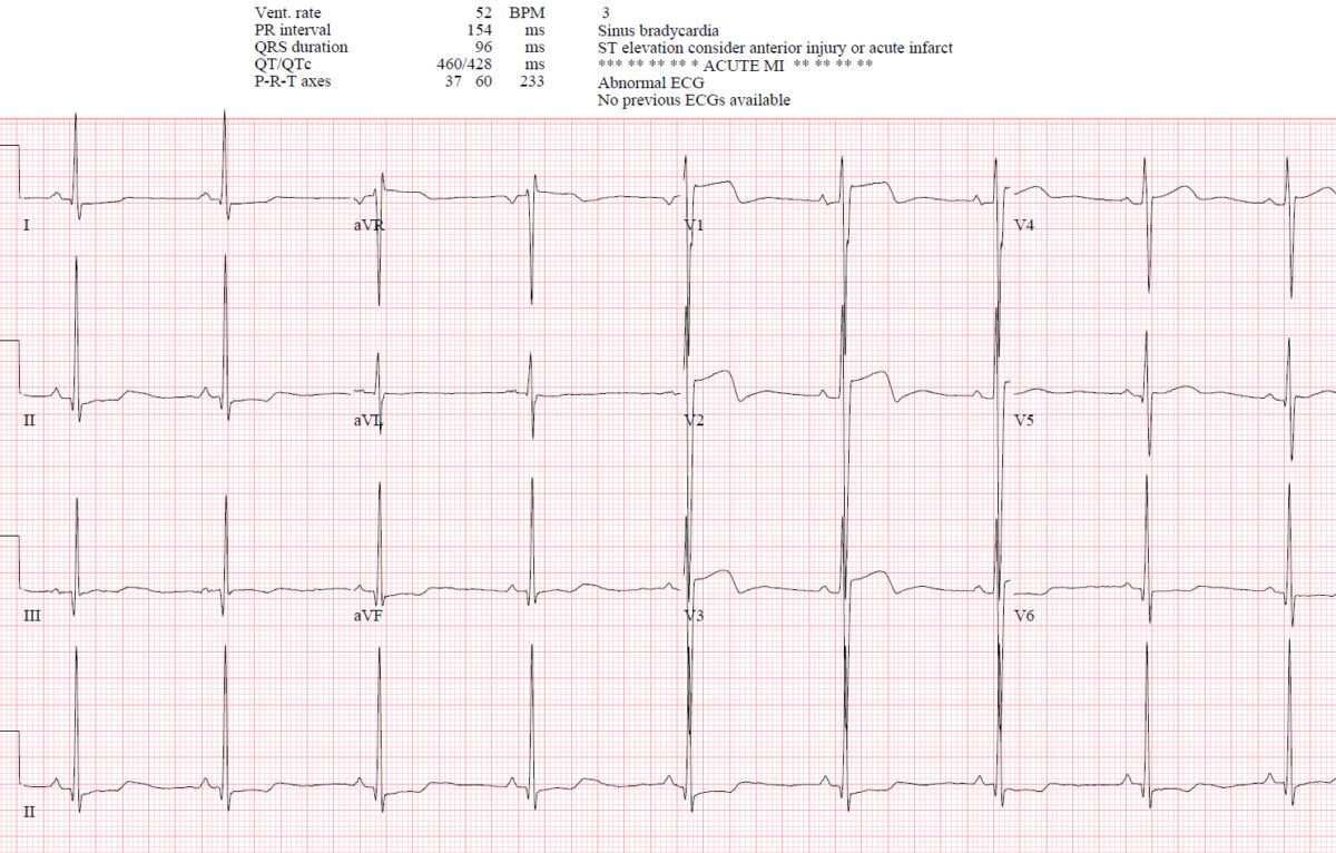 ST DEPRIMIDO mnemotécnico y Oclusión MI | Casos de ECG ...