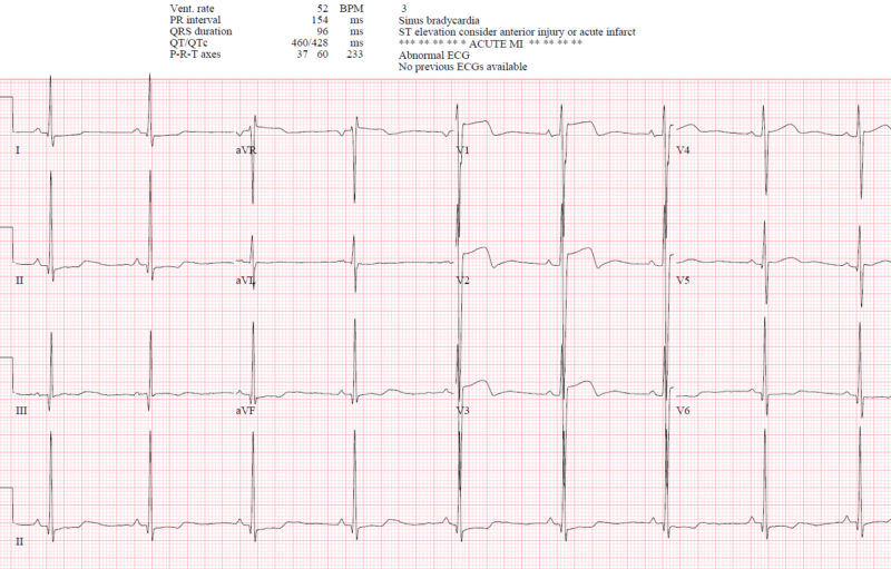 ST DEPRESSED mnemonic and Occlusion MI | ECG Cases | EM Cases