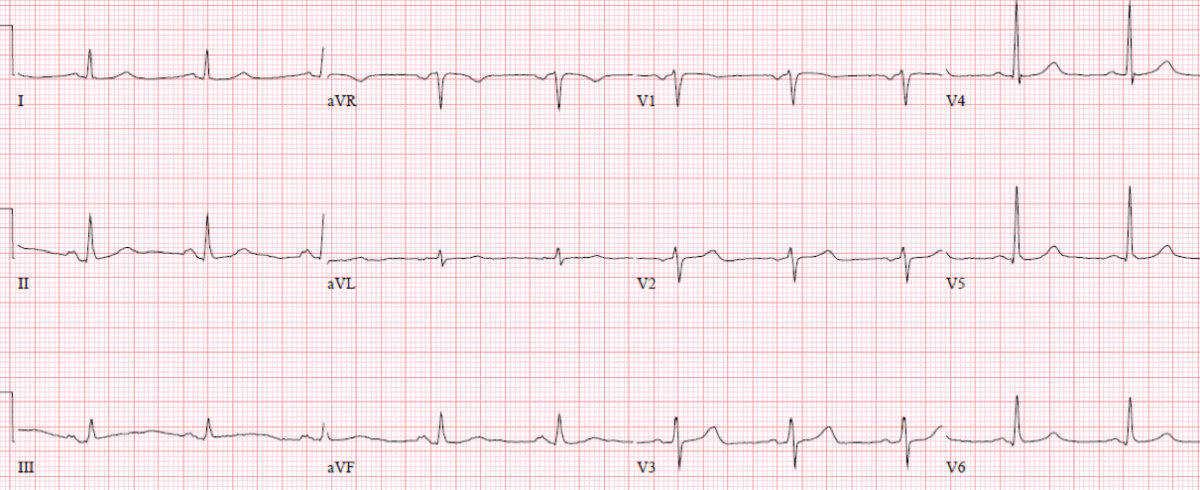 ST DEPRESSED mnemonic and Occlusion MI | ECG Cases | EM Cases