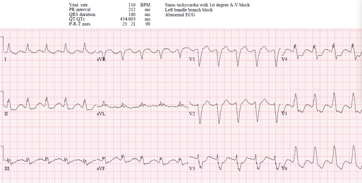 ST DEPRESSED mnemonic and Occlusion MI | ECG Cases | EM Cases