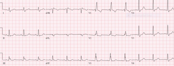 ST DEPRESSED mnemonic and Occlusion MI | ECG Cases | EM Cases
