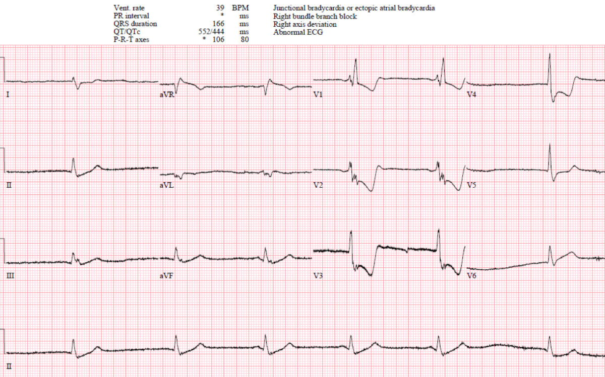 ST DEPRESSED mnemonic and Occlusion MI | ECG Cases | EM Cases
