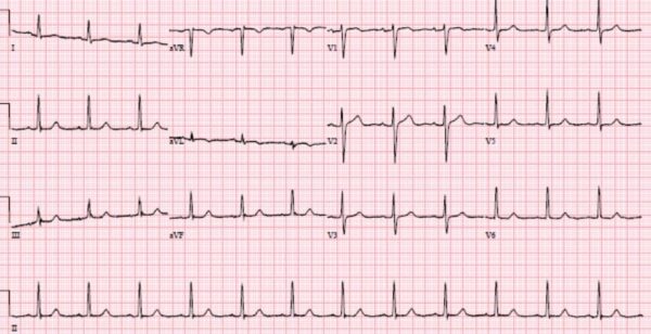 ST DEPRESSED mnemonic and Occlusion MI | ECG Cases | EM Cases