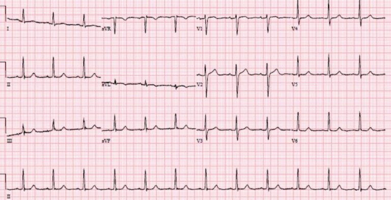 ST DEPRESSED mnemonic and Occlusion MI | ECG Cases | EM Cases