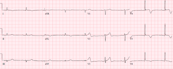 ST DEPRESSED mnemonic and Occlusion MI | ECG Cases | EM Cases