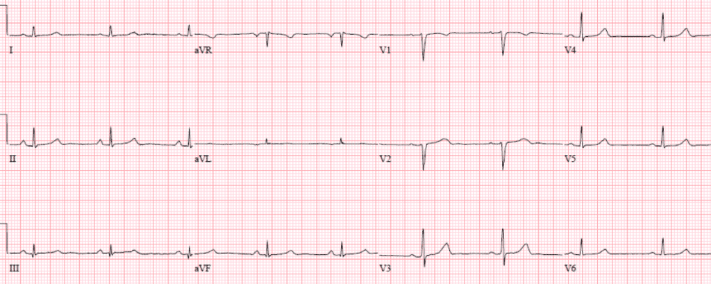 ST DEPRESSED mnemonic and Occlusion MI | ECG Cases | EM Cases