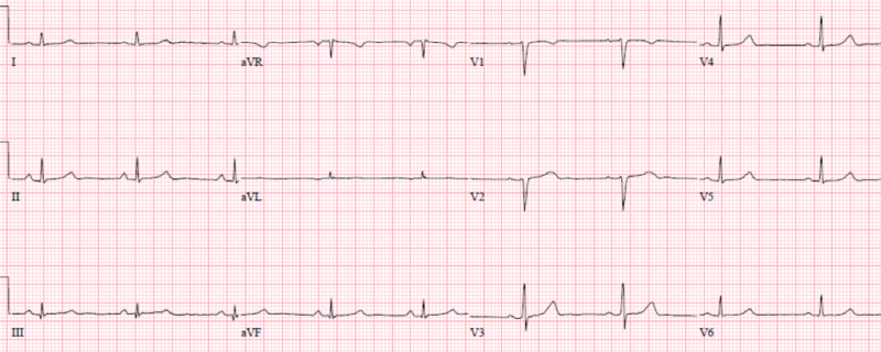 ST DEPRESSED mnemonic and Occlusion MI | ECG Cases | EM Cases