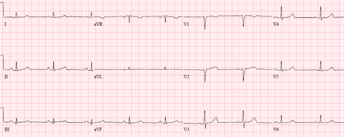 ST DEPRESSED mnemonic and Occlusion MI | ECG Cases | EM Cases