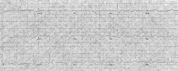 ST DEPRESSED mnemonic and Occlusion MI | ECG Cases | EM Cases