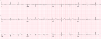 ST DEPRESSED mnemonic and Occlusion MI | ECG Cases | EM Cases