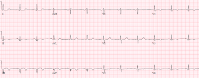 ST DEPRESSED mnemonic and Occlusion MI | ECG Cases | EM Cases