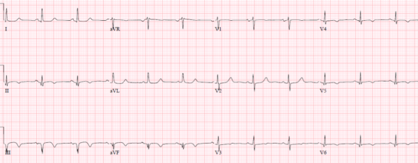 ST DEPRESSED mnemonic and Occlusion MI | ECG Cases | EM Cases