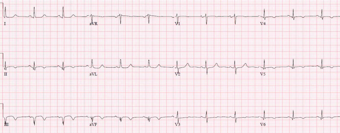 ST DEPRESSED mnemonic and Occlusion MI | ECG Cases | EM Cases