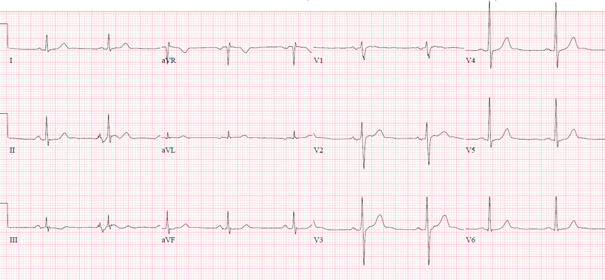 ST DEPRESSED mnemonic and Occlusion MI | ECG Cases | EM Cases