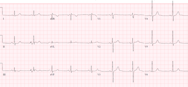 ST DEPRESSED mnemonic and Occlusion MI | ECG Cases | EM Cases