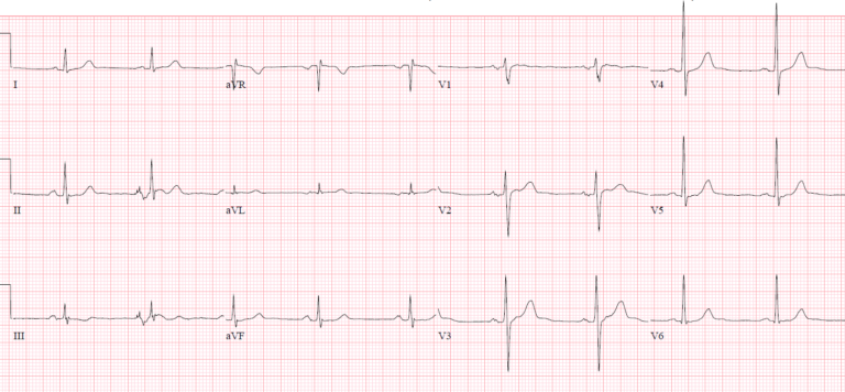 ST DEPRESSED mnemonic and Occlusion MI | ECG Cases | EM Cases