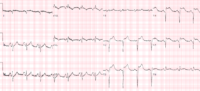 EM Cases | ECG Cases 19: tachycardias