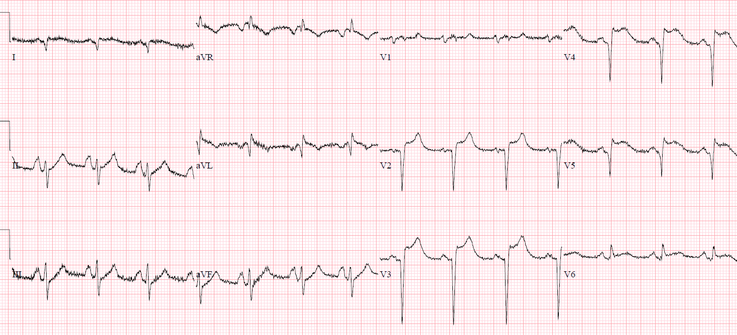 EM Cases | ECG Cases 19: tachycardias