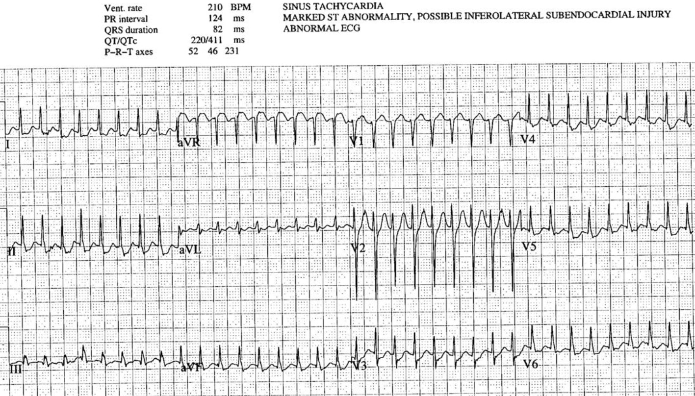 EM Cases | ECG Cases 19: tachycardias