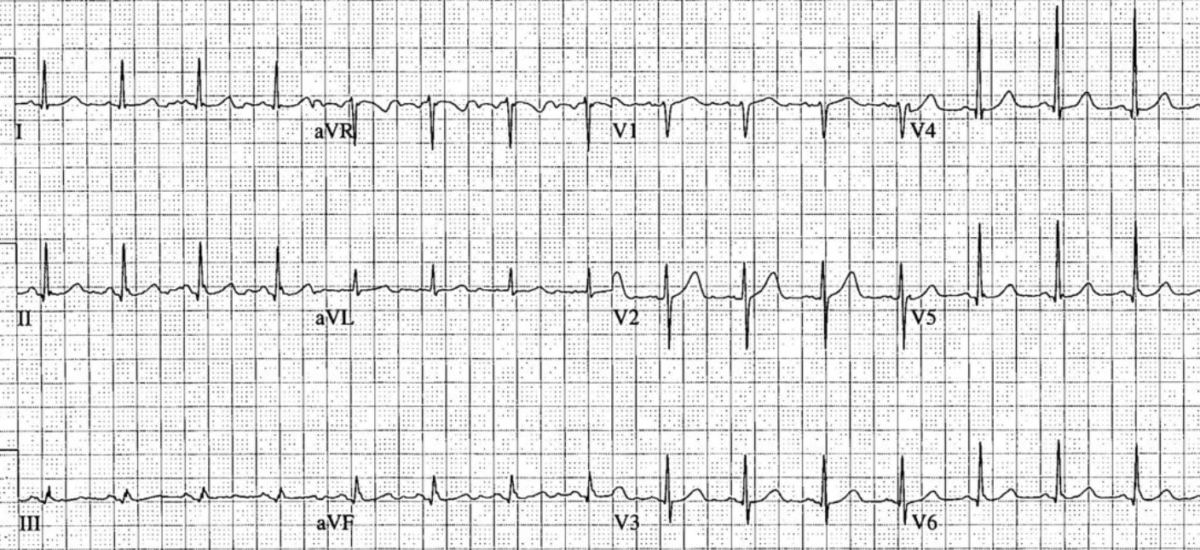 EM Cases | ECG Cases 19: tachycardias