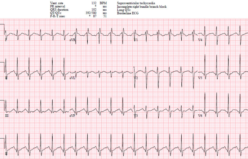 EM Cases | ECG Cases 19: tachycardias