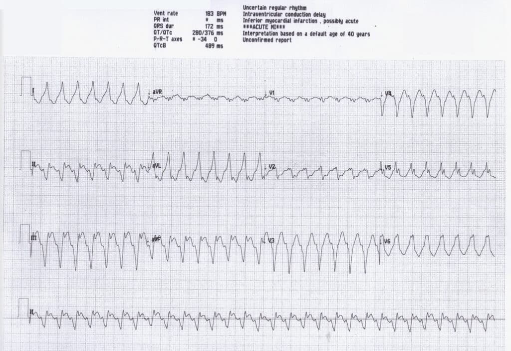 EM Cases | ECG Cases 19: tachycardias